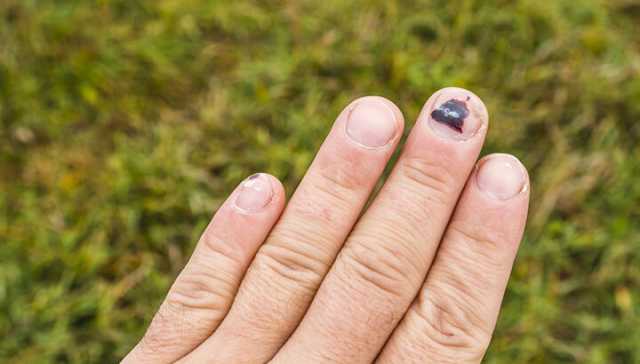 What Your Fingernail Lines Say About Your Health